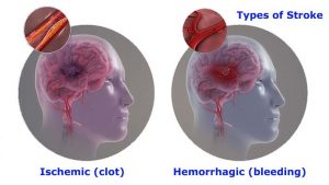 National Stroke Awareness Month: Stroke Compensation Claims